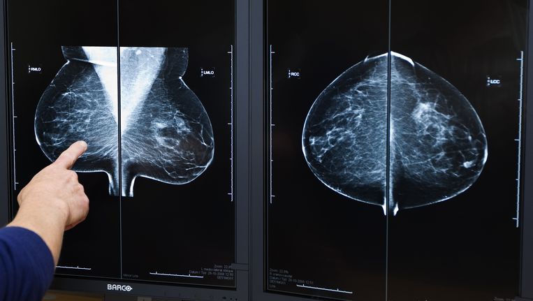 Therapie kan agressieve borstkanker juist bevorderen | De Volkskrant