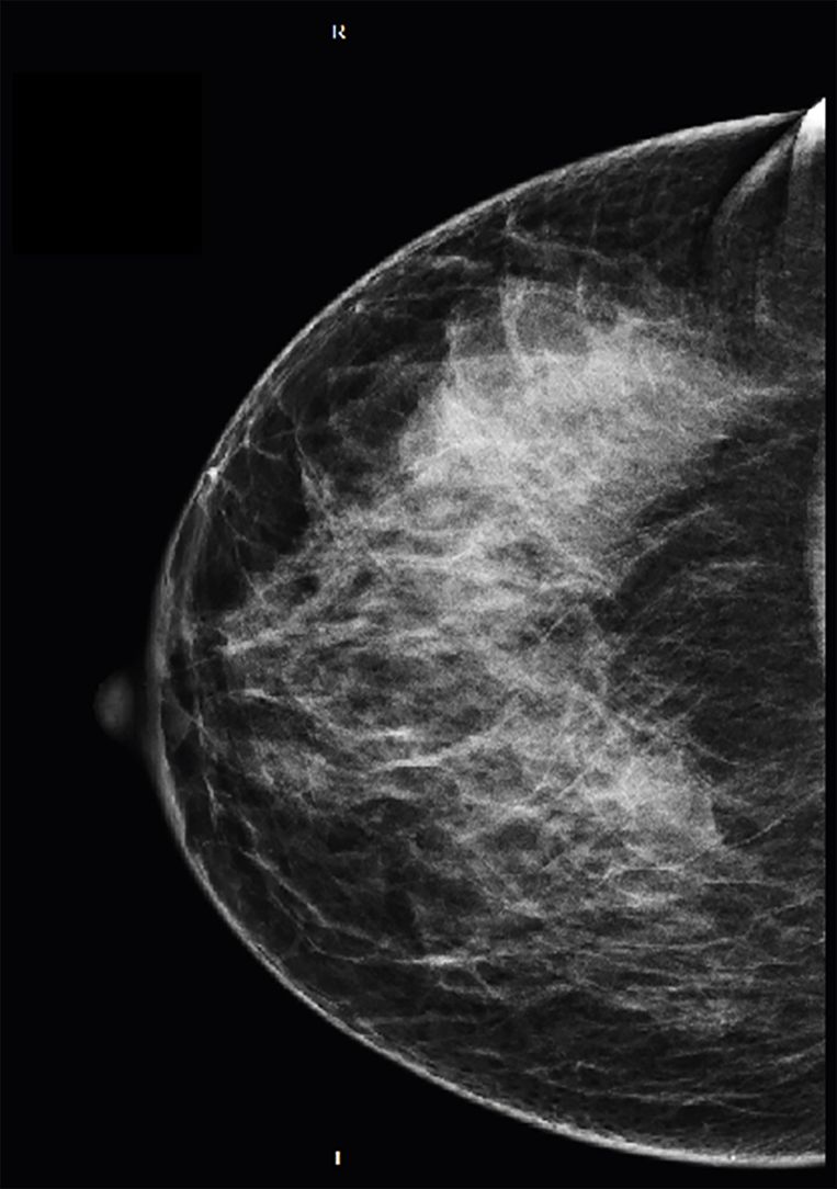 Redt preventieve screening op borstkanker levens? | De Volkskrant